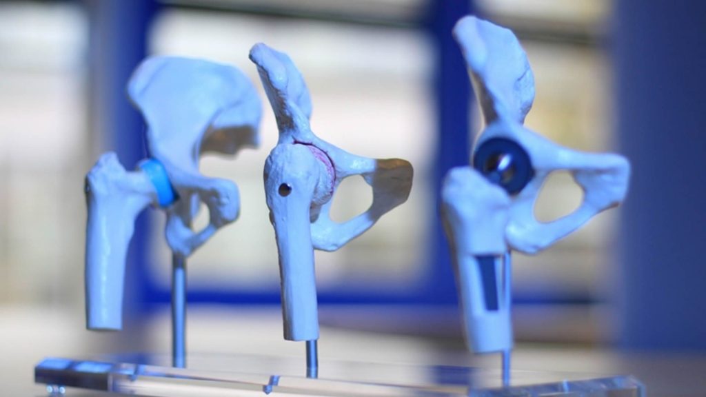 Was versteht man unter Arthrose? - Arthrose Journal