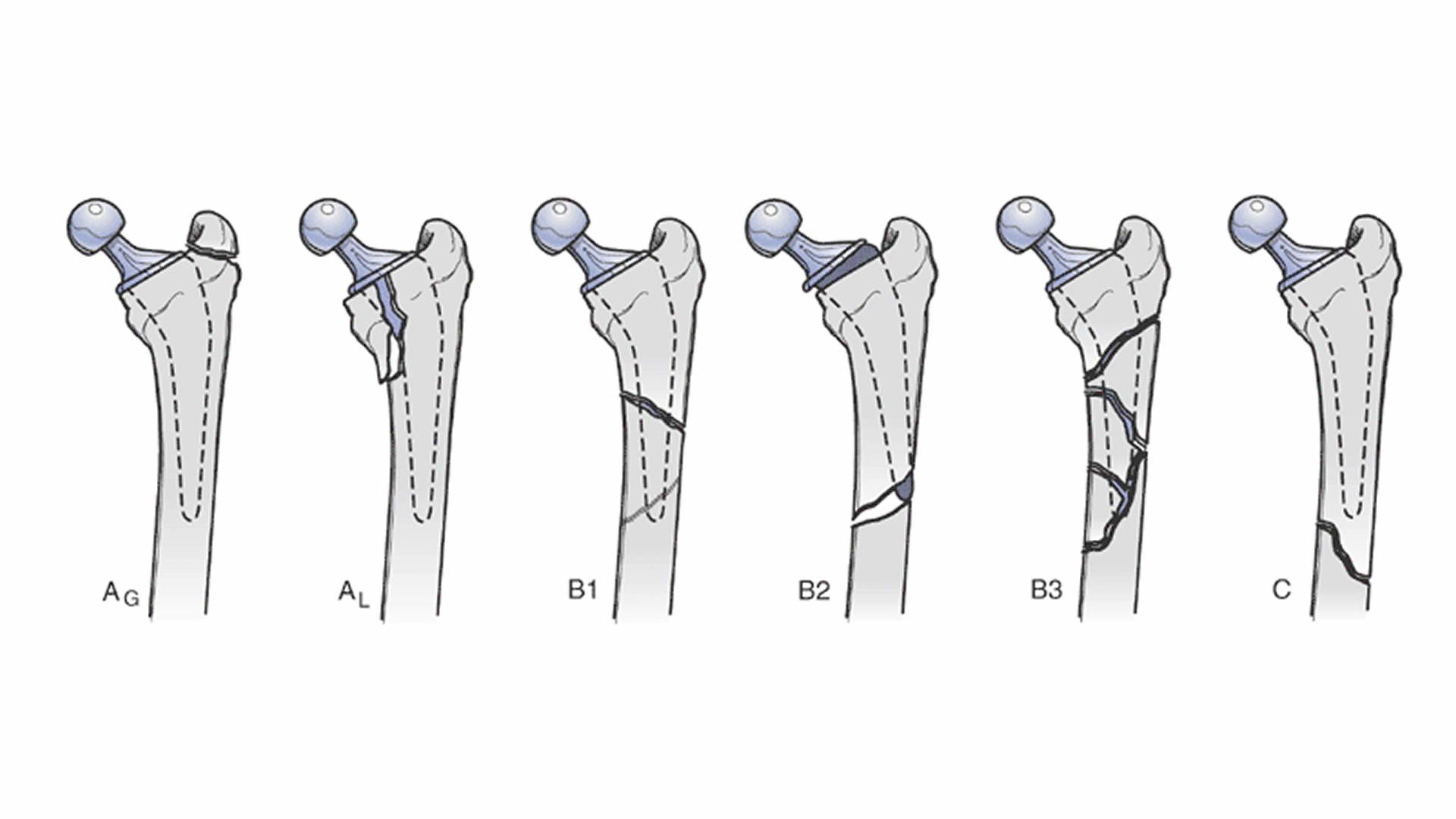 Periprothetische Frakturen: Wenn Knochen um den Prothesen brechen
