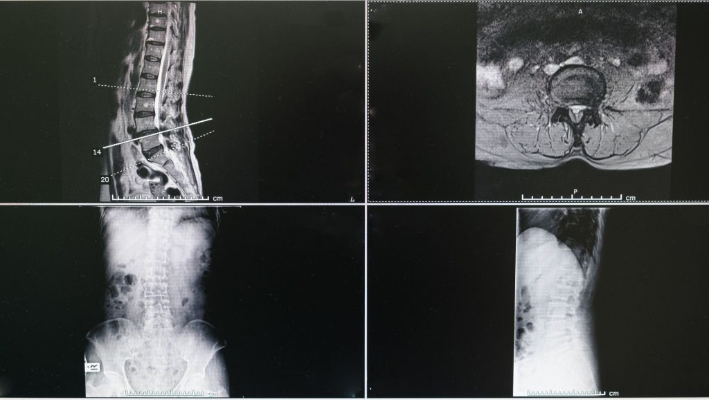Arthrose an der Lendenwirbelsäule: eine häufige Ursache für ...
